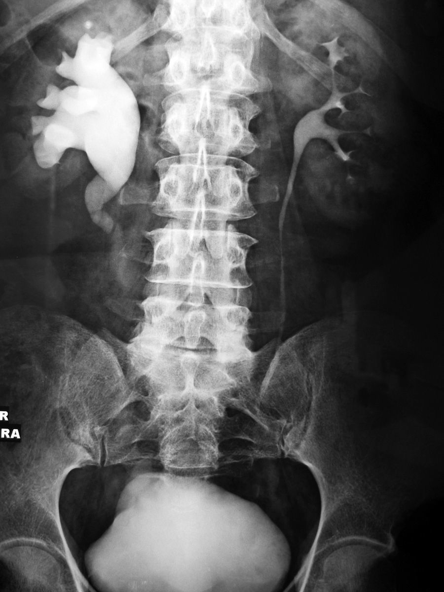 Laparoscopic ureteral replacement by Boari flap: Multi-institutional ...