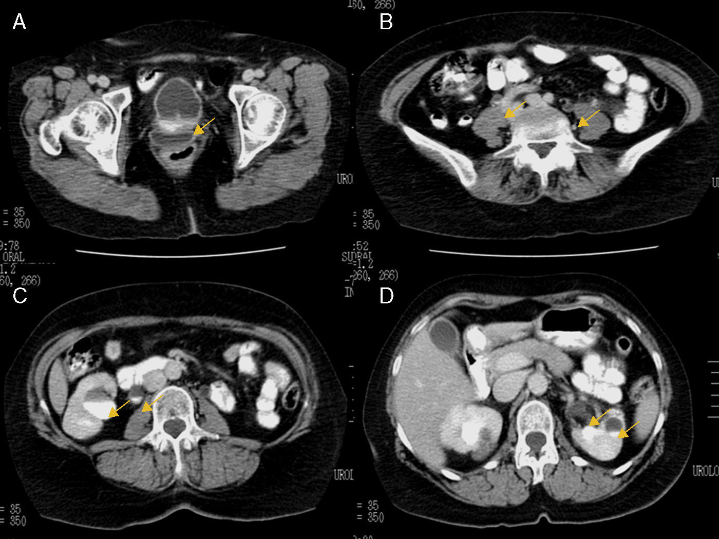 Radical cystectomy, hysterectomy with double adnexectomy and bilateral ...