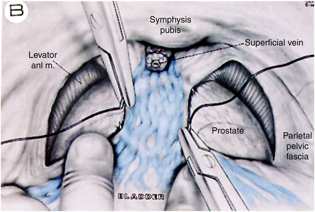 Radical retropubic prostatectomy: control of Santorini's venous plexus ...