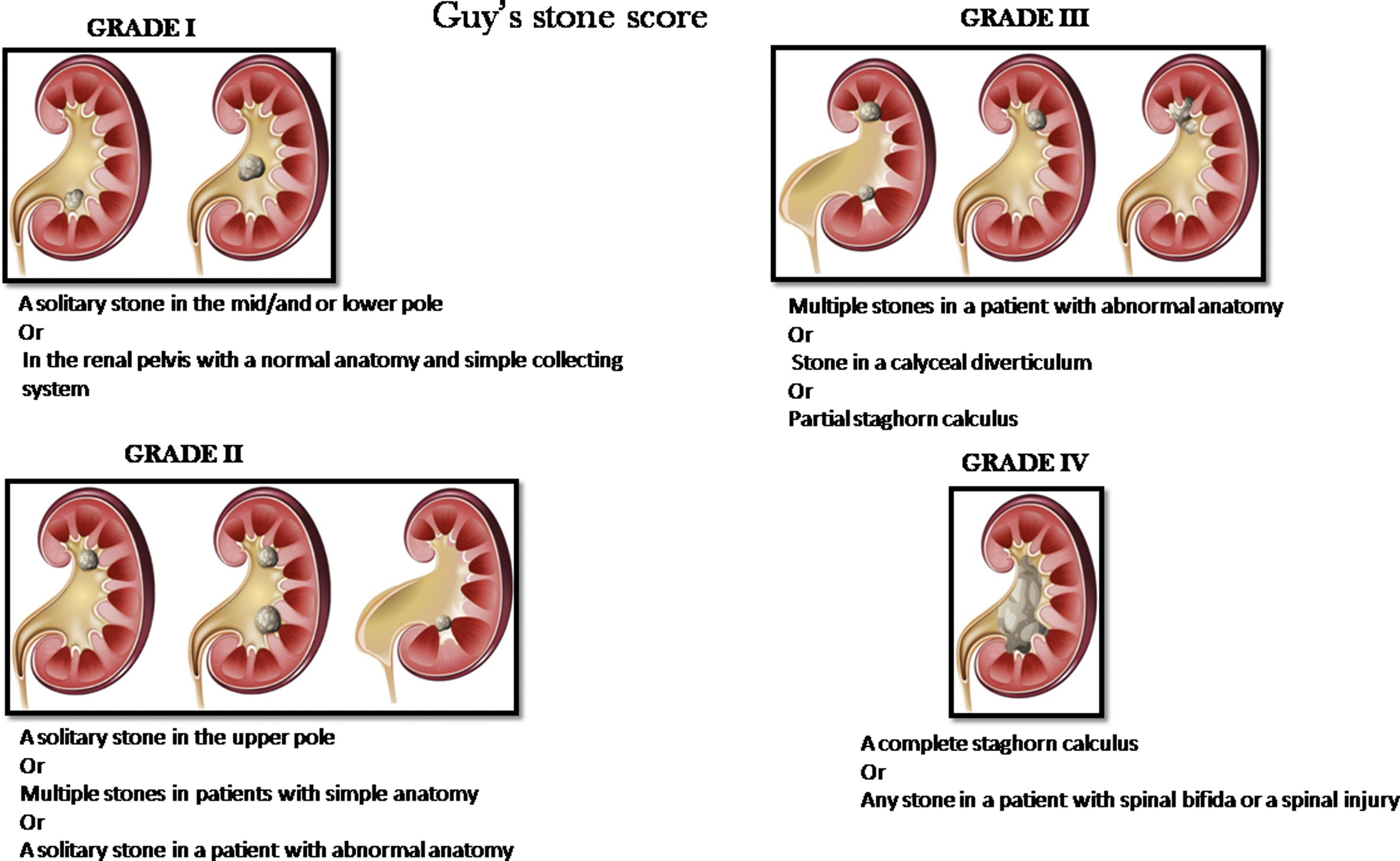 Is Guy’s stone score useful for predicting outcomes in percutaneous ...