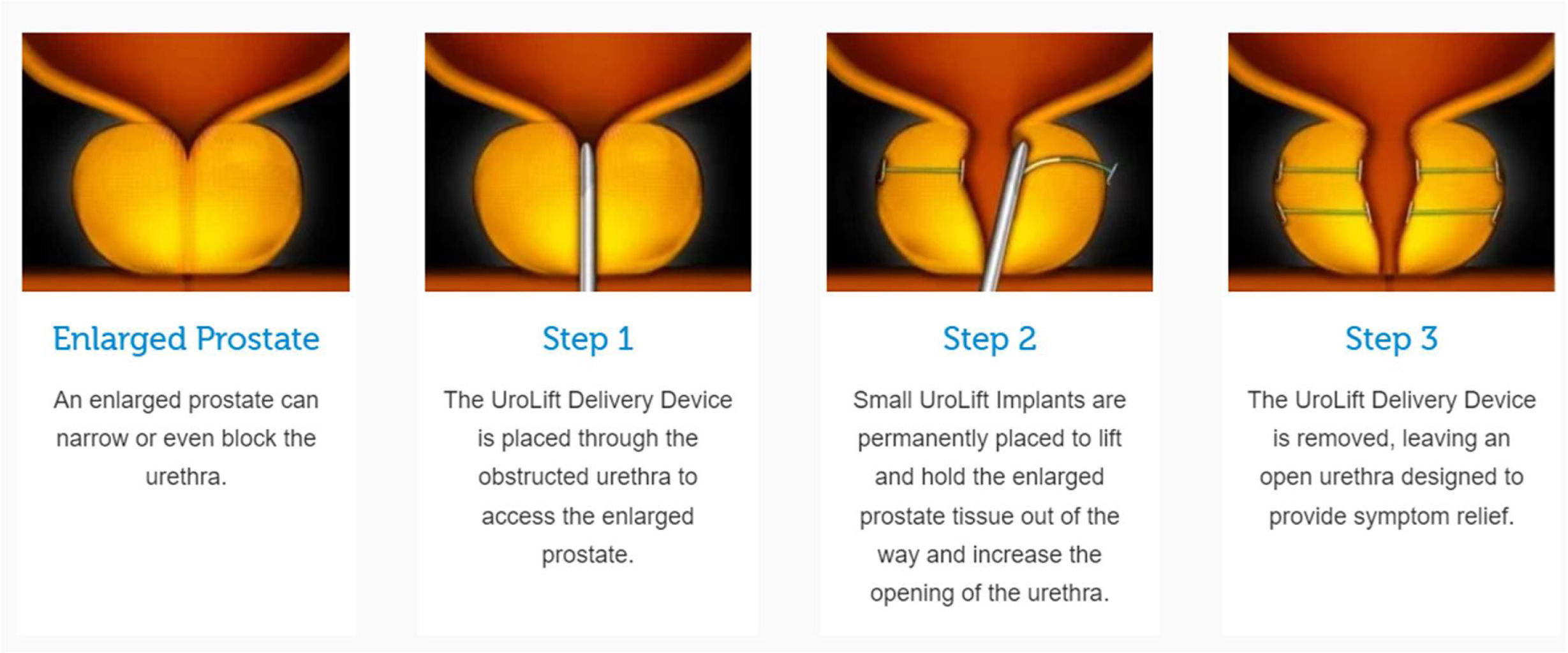 Clinical application of the UroLift® prostatic urethral lift in Spain ...