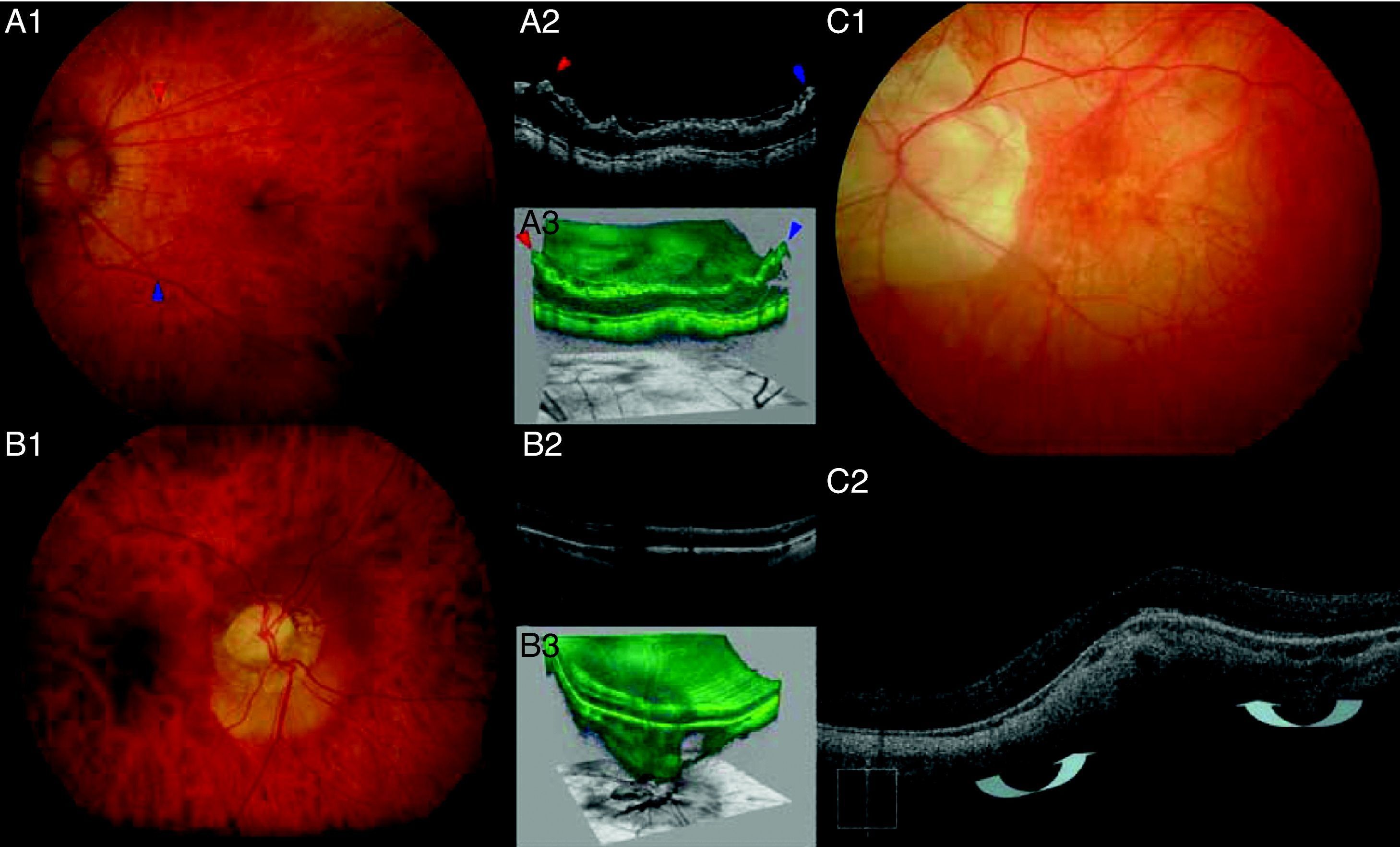 Rediscovering the macula of high myopia in the xxi century | Archivos ...