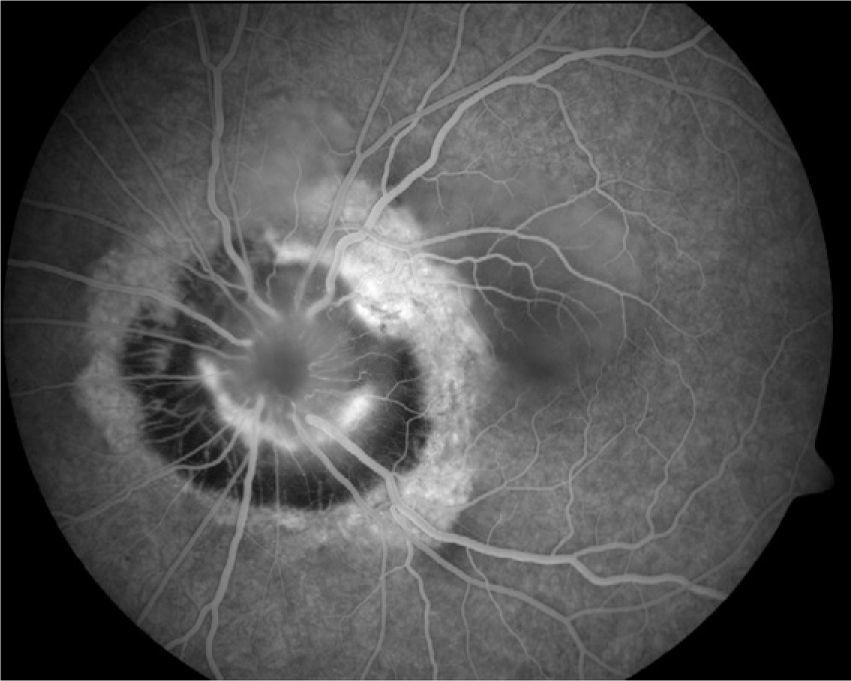 Retinal detachment associated with Morning Glory syndrome | Archivos de ...