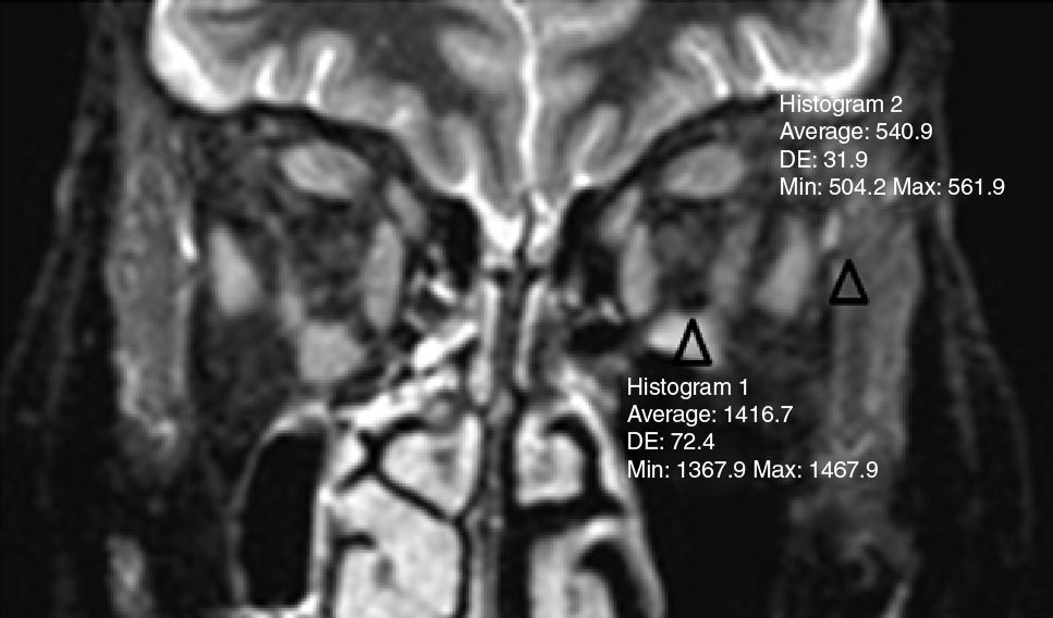 Short-tau inversion-recovery (STIR) sequence magnetic resonance imaging ...