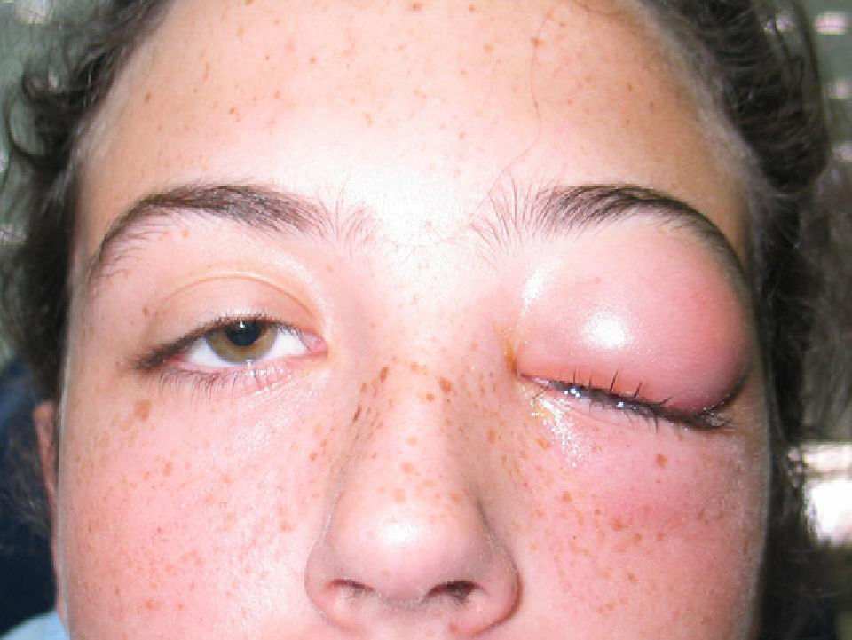 Unsuccessful treatment with OK-432 picibanil for orbital lymphangioma ...