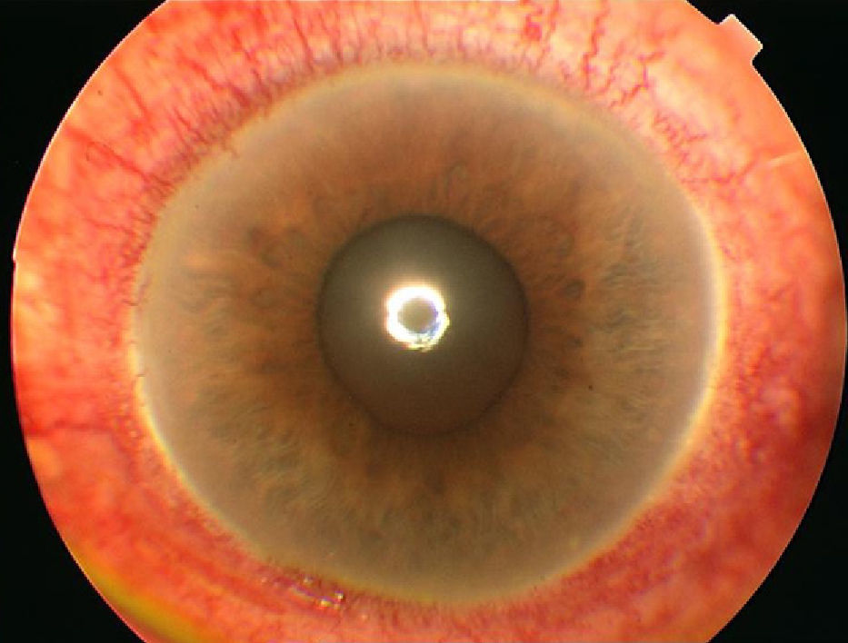 Herpetic endotheliitis and trabeculitis with delayed corneal ...