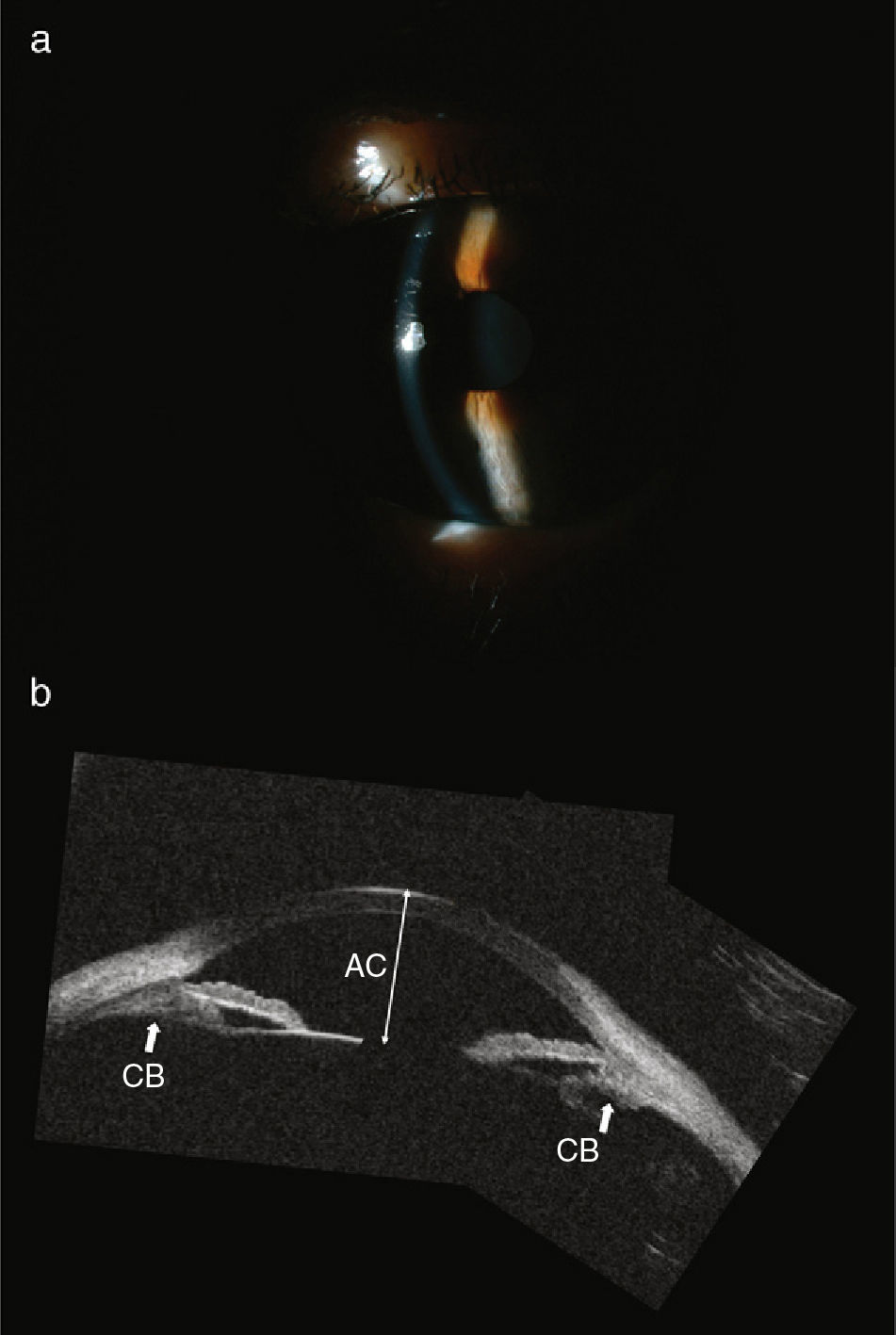 Angle-closure glaucoma secondary to topiramate use | Archivos de la ...
