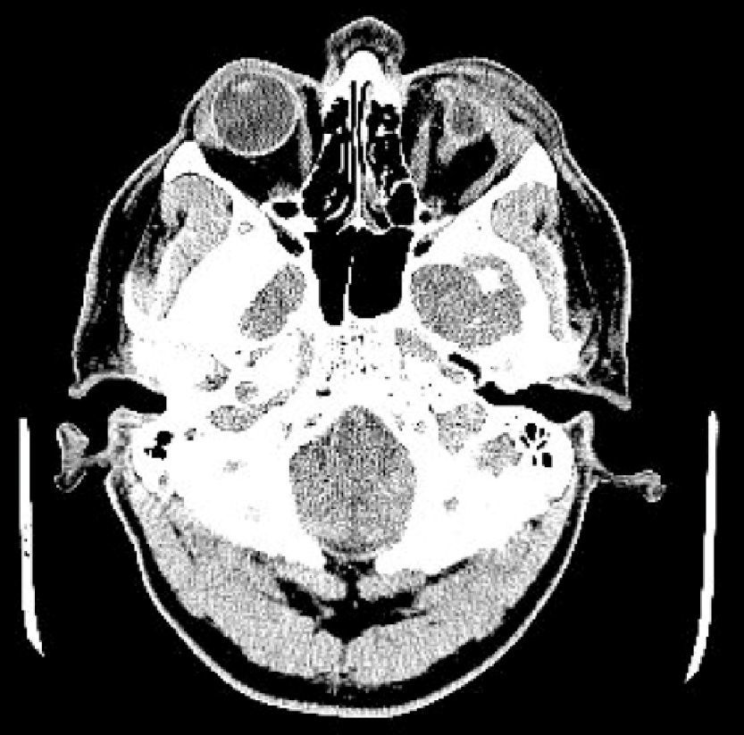 Atypical traumatic scleral rupture: Presentation of a case | Archivos ...