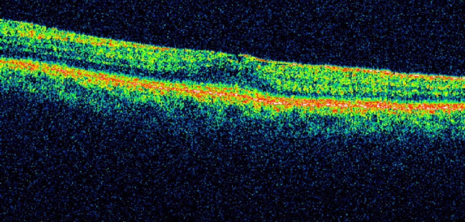 Clinical features of Goldmann–Favre vitreoretinal degeneration ...