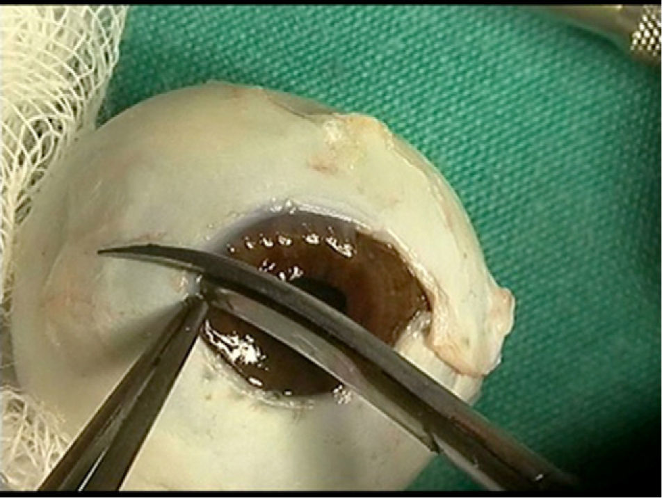 Technique for removing donor sclera by eyeball extrusion | Archivos de ...