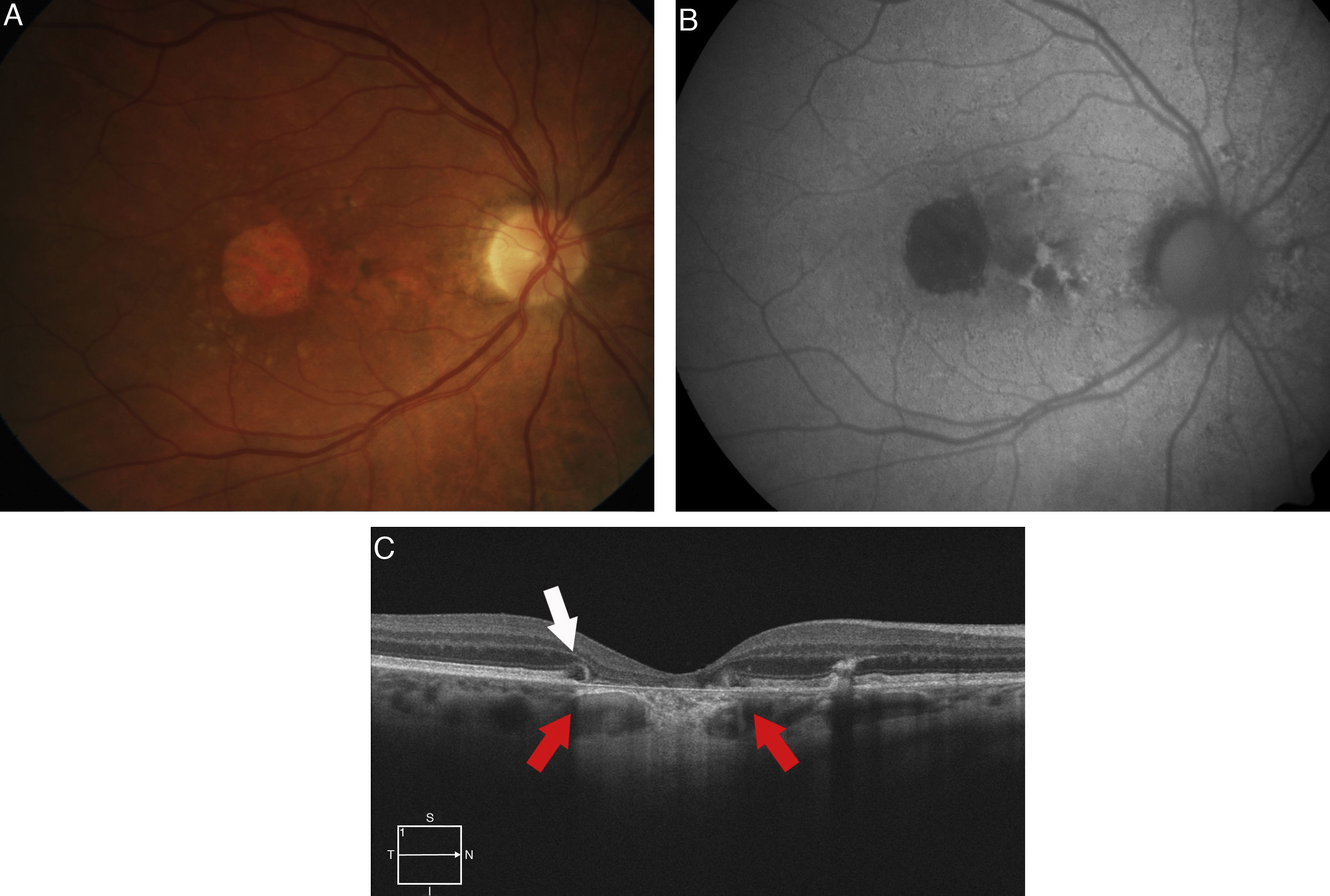 Outer retinal tubulation analysis in cases of macular dystrophy ...