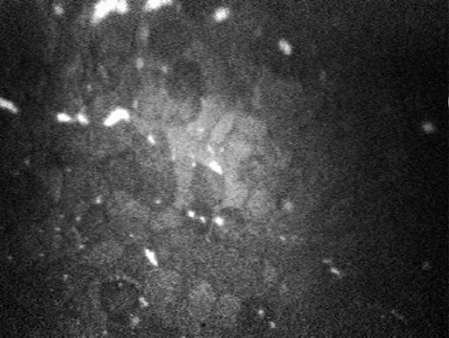 Corneal chrysiasis. Gold salt deposits in the cornea in a patient with ...