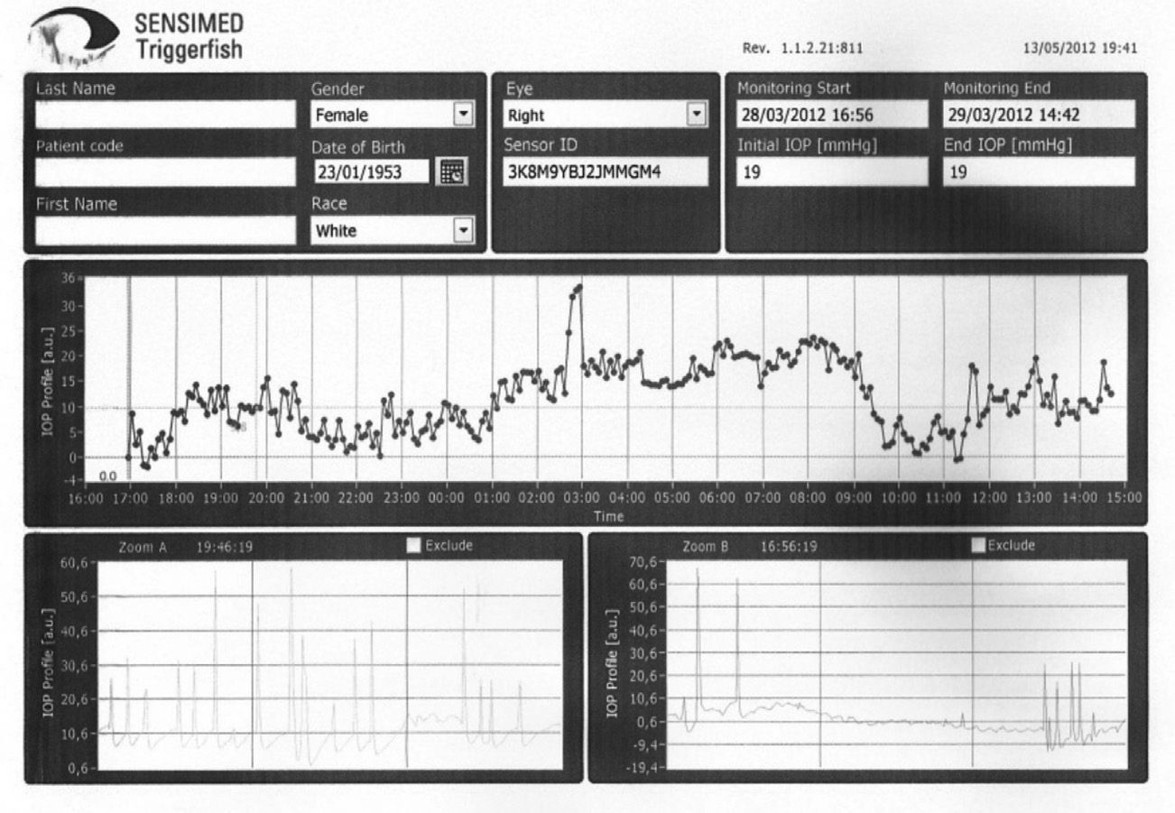 Sensimed Triggerfish® as a new system for continuous recording of 24 ...