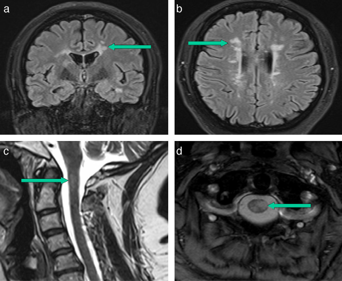 C-ANCA positive necrotising scleritis and multiple sclerosis compatible ...