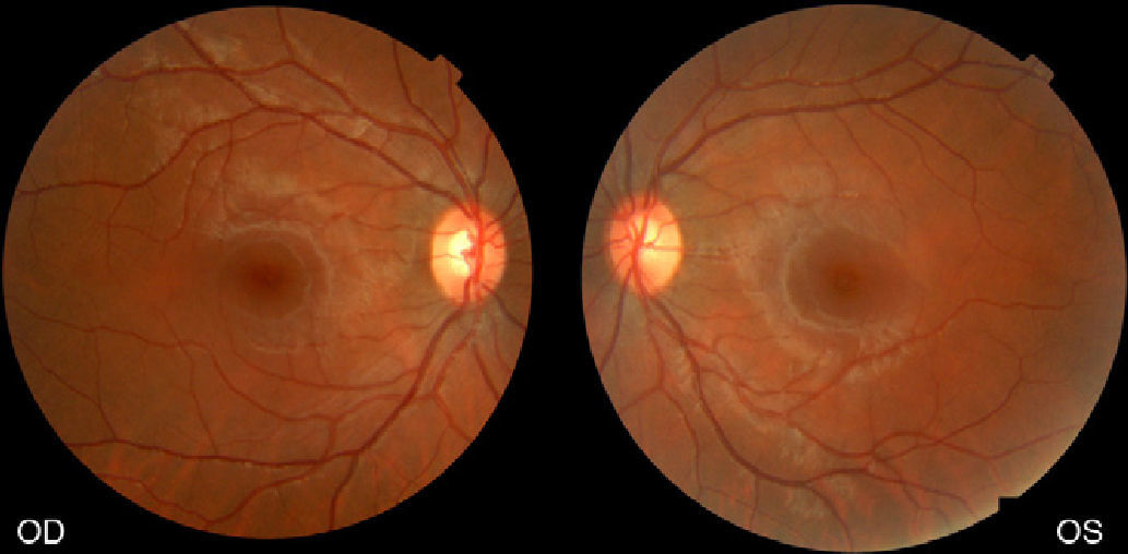 Acute retinal pigment epitheliitis. Diagnosis using optical coherence ...