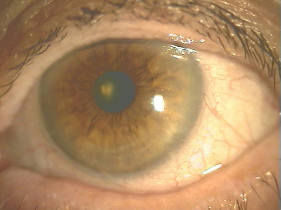 Atypical melanocytic nevus of the limbus. A case report | Archivos de ...