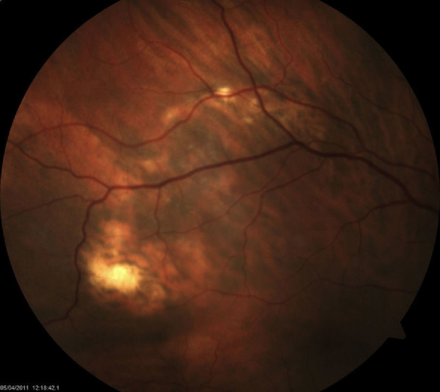 Sclerochoroidal calcification associated with hypovitaminosis D ...