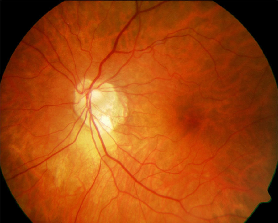 Peripapillary intrachoroidal cavitation in pathological myopia ...