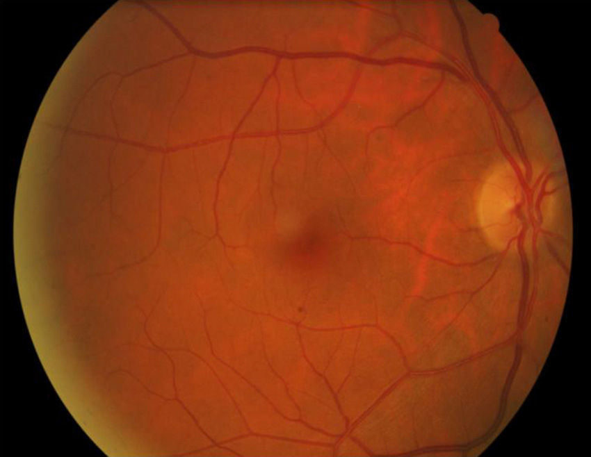 Retinal venous thrombosis in a young patient with coagulation factor ...