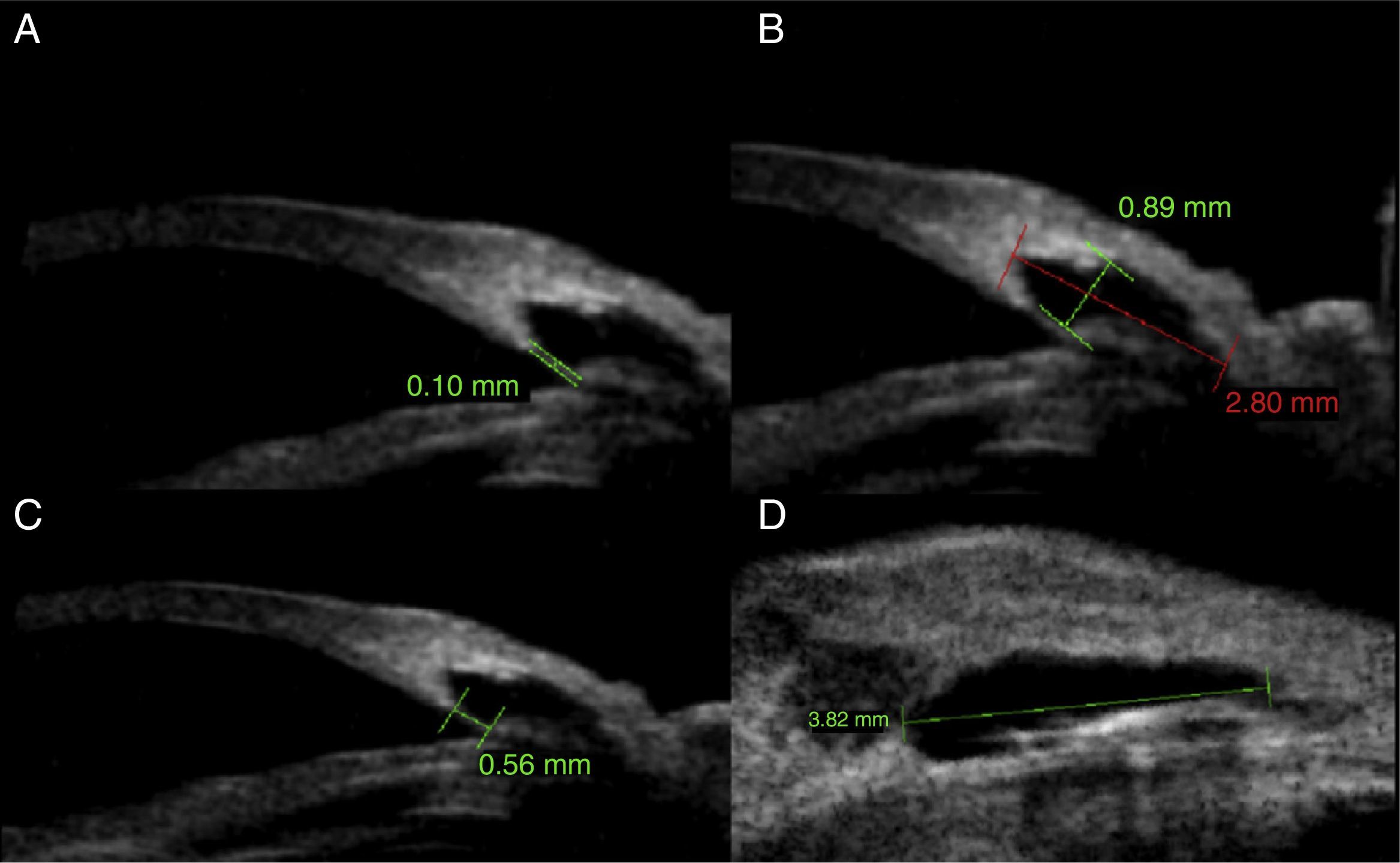 An ultrasound biomicroscopy study after deep sclerectomy with ...