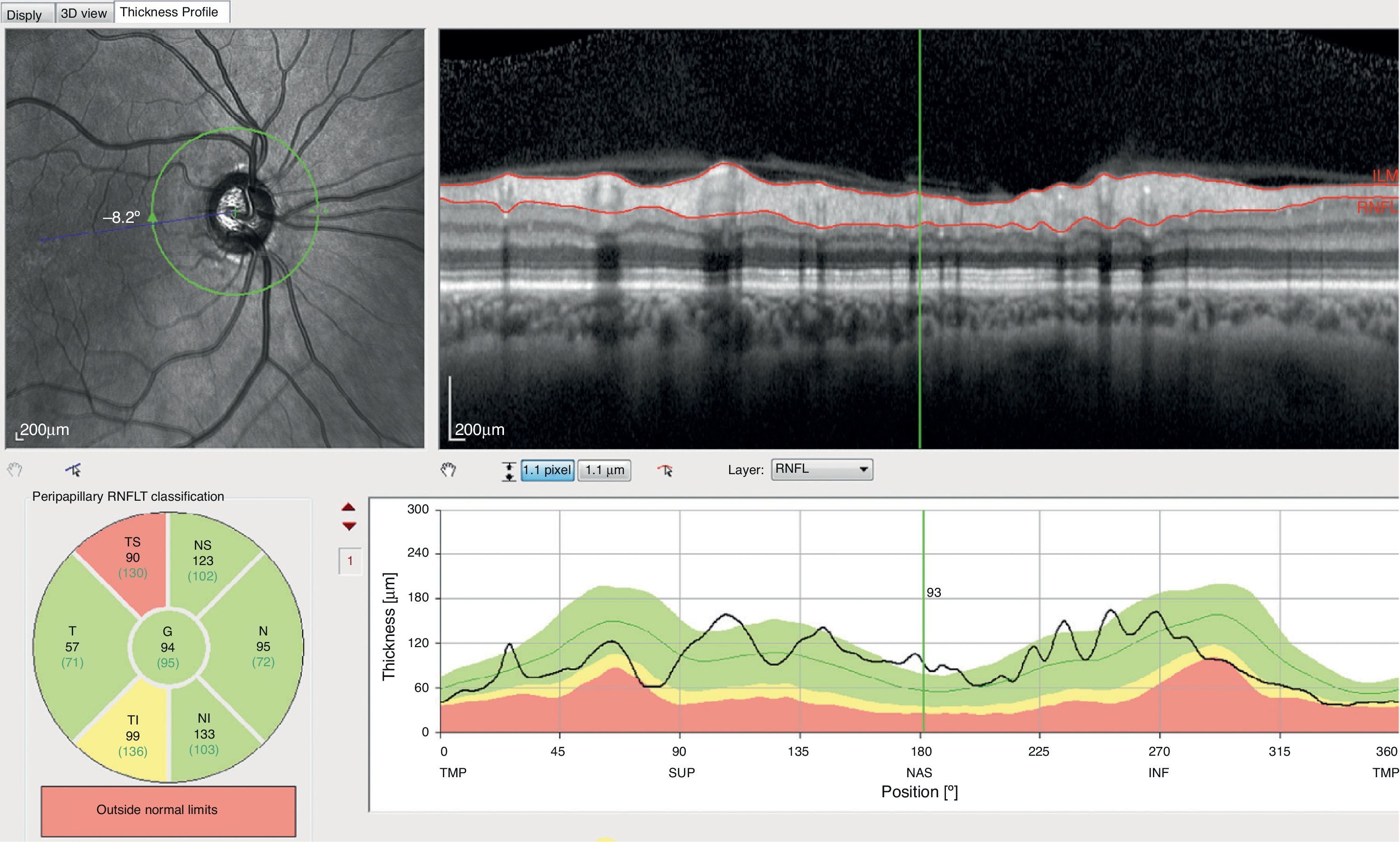 Correlating cup-to-disc ratios measured by HRT-III, SD-OCT and the new ...