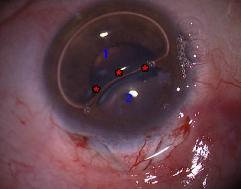 Bubble mirror technique for express shunt surgery | Archivos de la ...