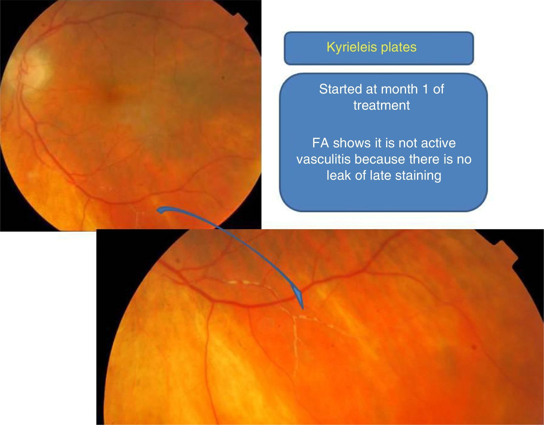 Bilateral acute retinal necrosis due to varicella zóster virus in an ...