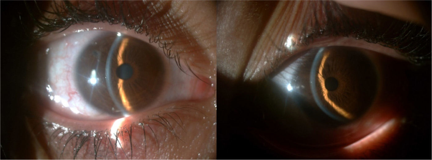 Angle closure secondary to the use of lorazepam in patient with myopia ...