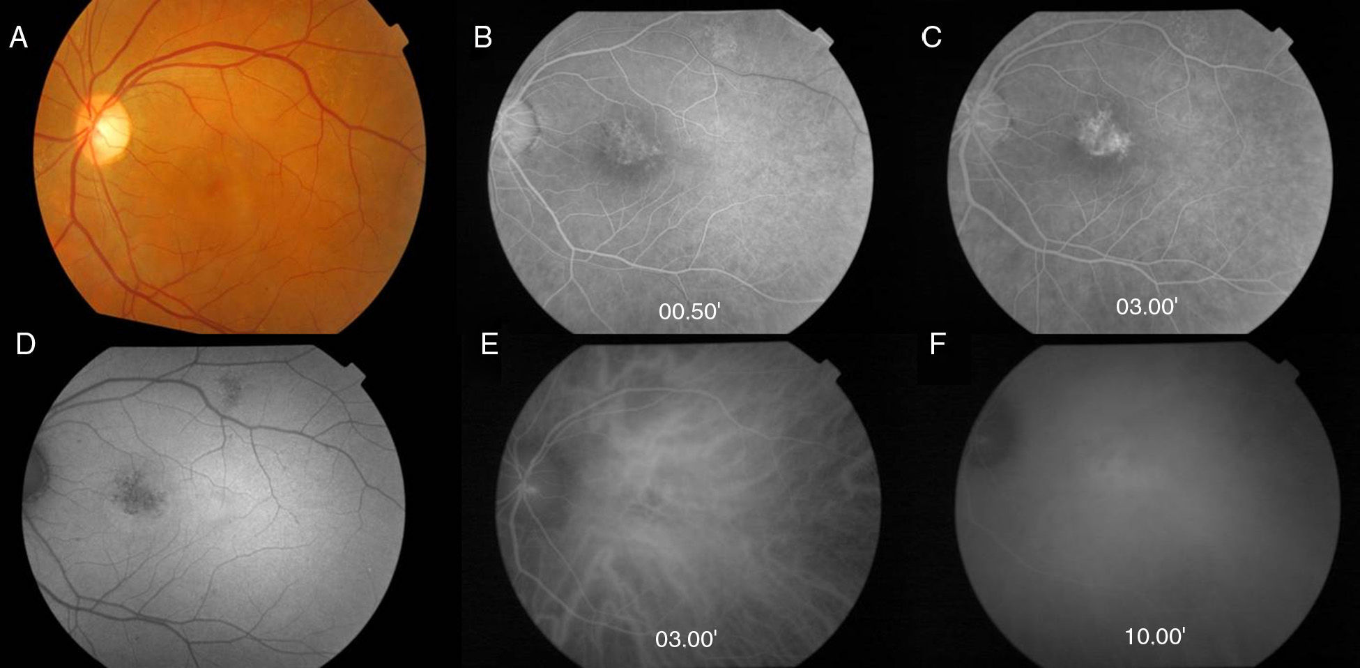 Focal choroidal excavation: Clinical findings and complications ...
