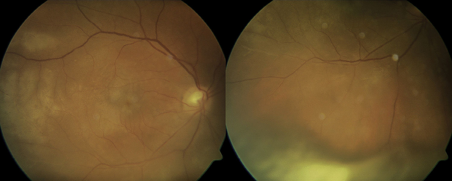 Spectral domain optical coherence tomography in Celestone® retinal ...