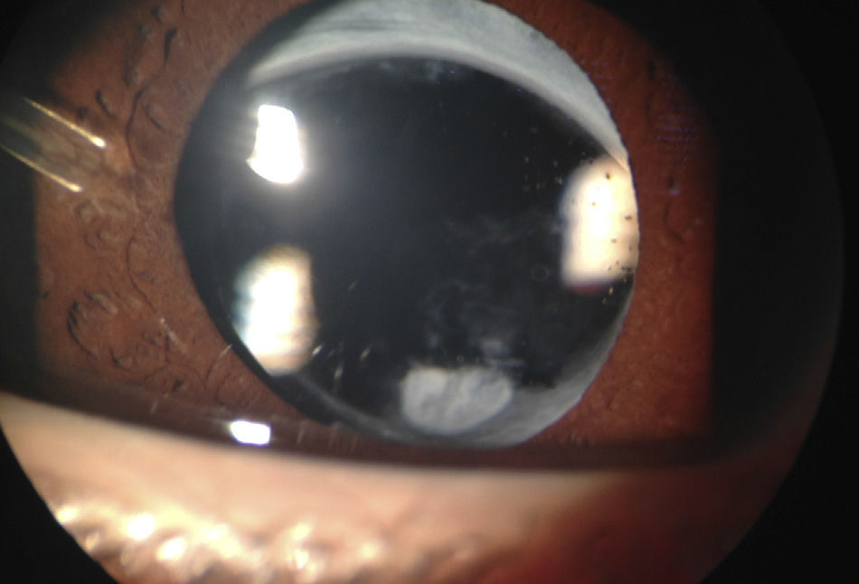 Complicated uveitis in late onset juvenile idiopathic psoriatic ...