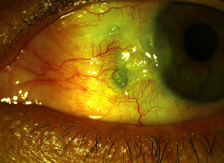 Scleral patch graft in the management of necrotising scleritis with ...