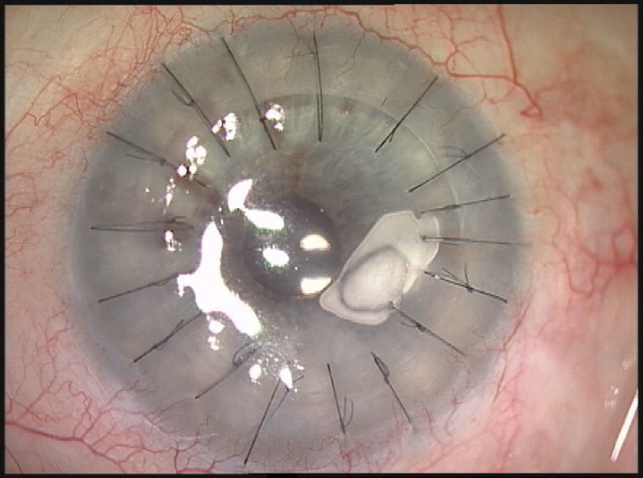 Determination of phosphate concentration in glaucoma eye drops ...
