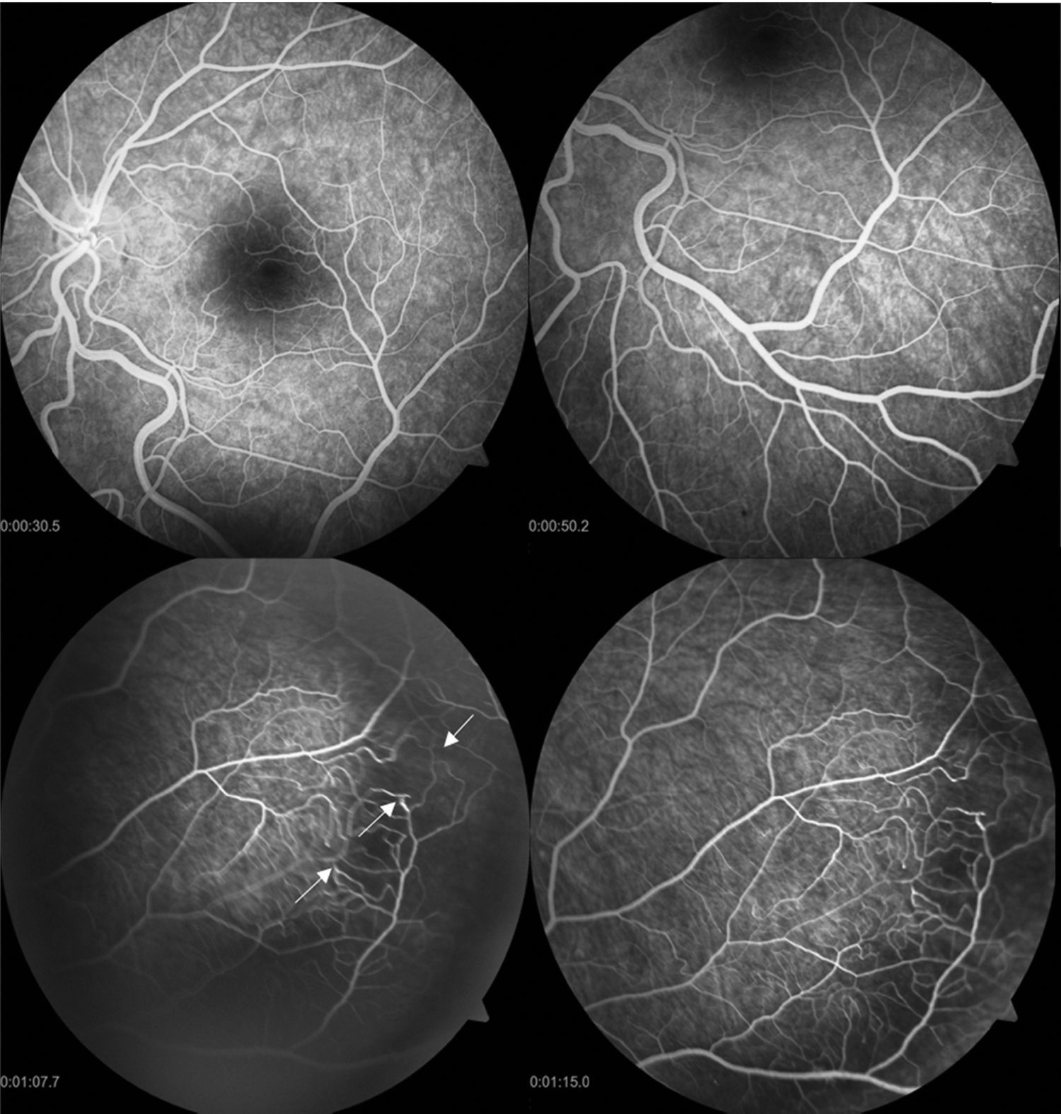 Congenital retinal macrovessel associated with retinal peripheral ...