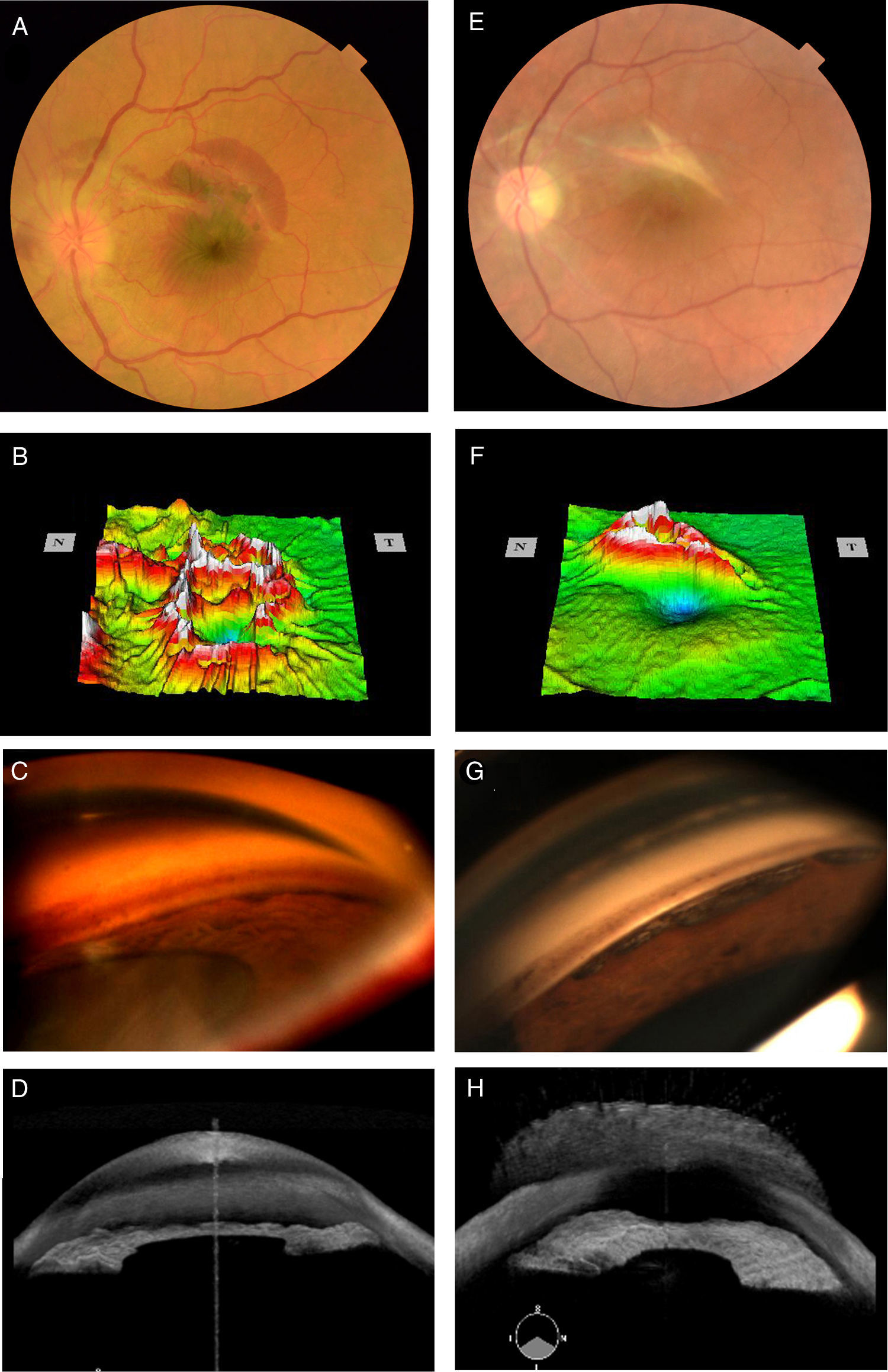 Traumatic cyclodialysis treated with transscleral ciclodiode laser ...
