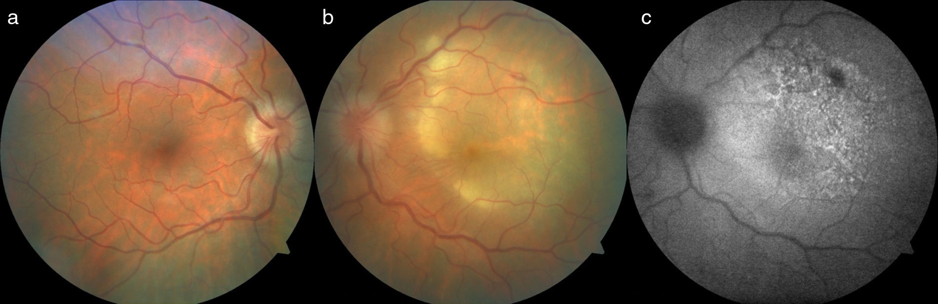 Syphilitic posterior placoid chorioretinitis as initial presentation of ...