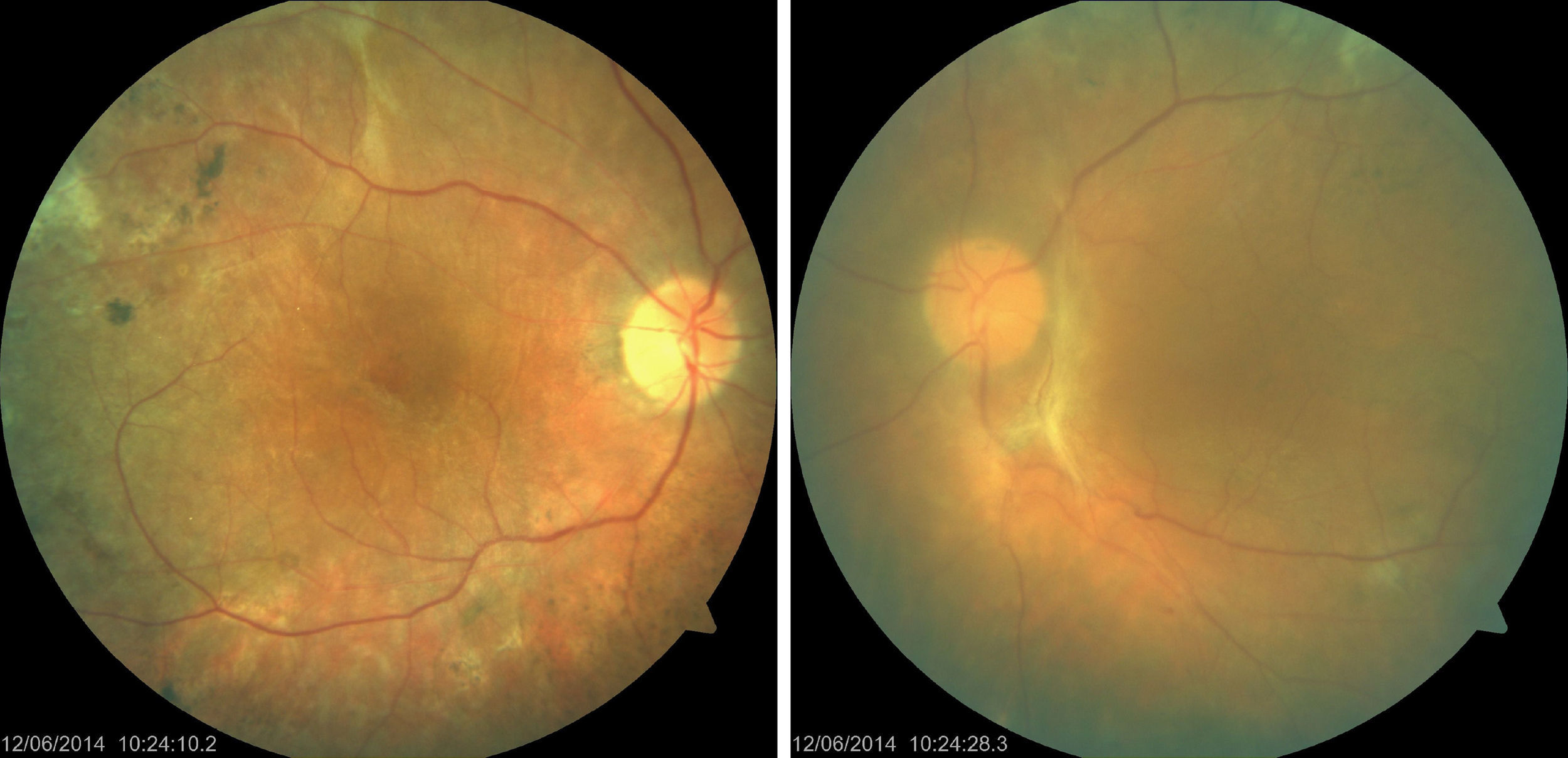 Bilateral exudative retinal detachment associated with central serous ...