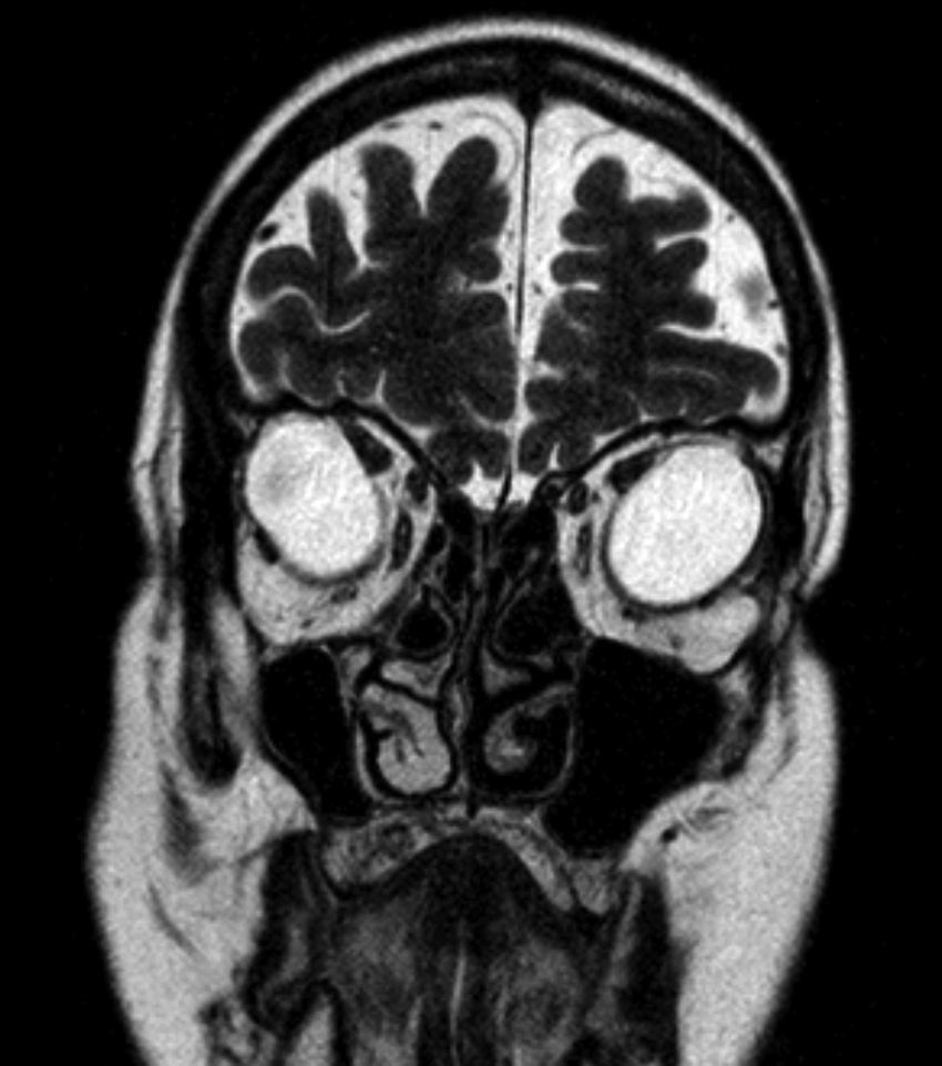 Strabismus-associated myopia. Review | Archivos de la Sociedad Española ...