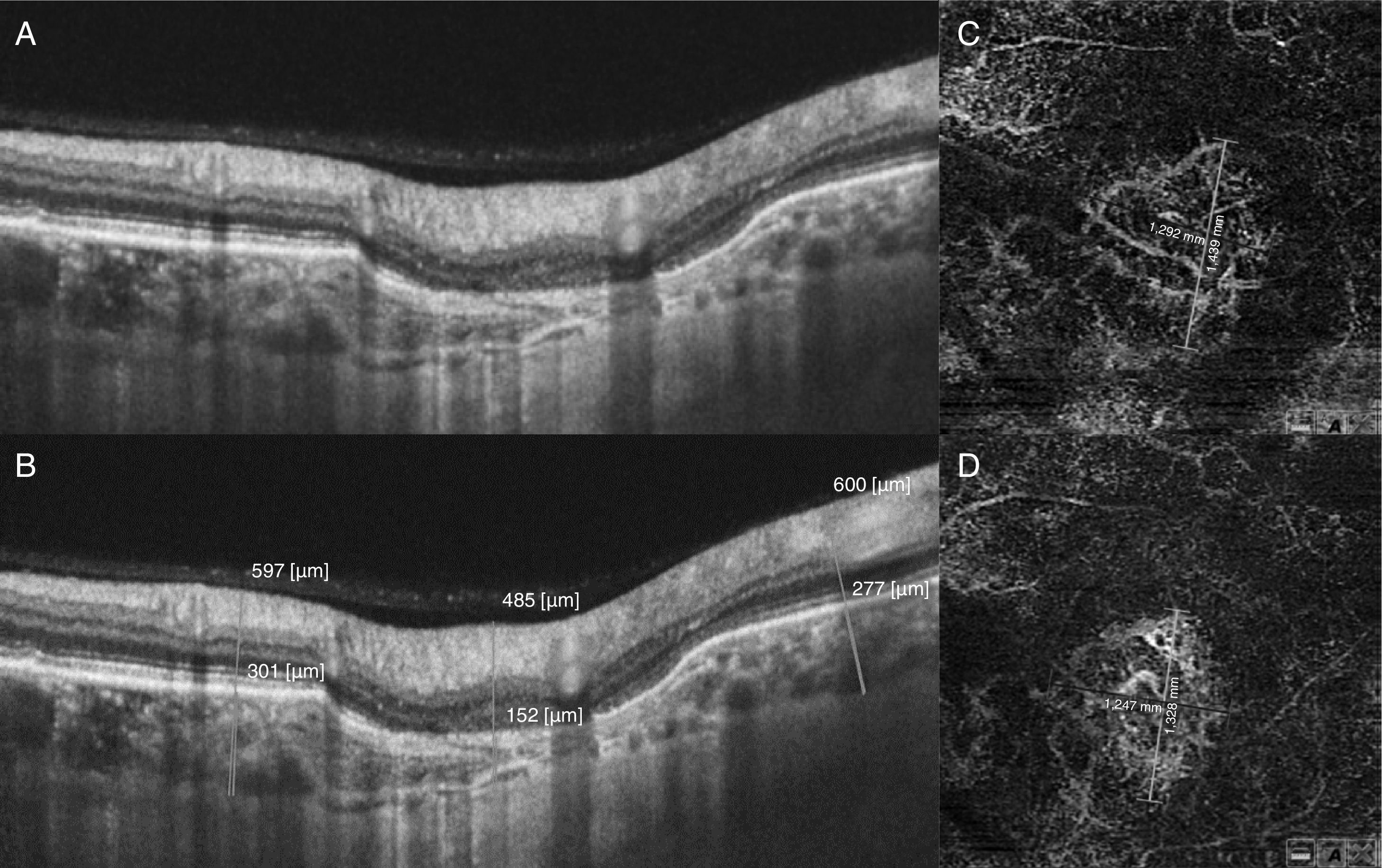 Choroidal osteoma with choroidal excavation and associated neovascular ...