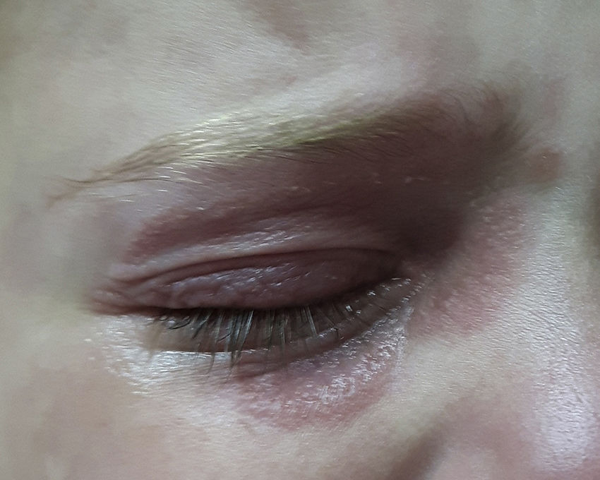 Eyelid tinea with blepharitis due to Microsporum canis | Archivos de la ...