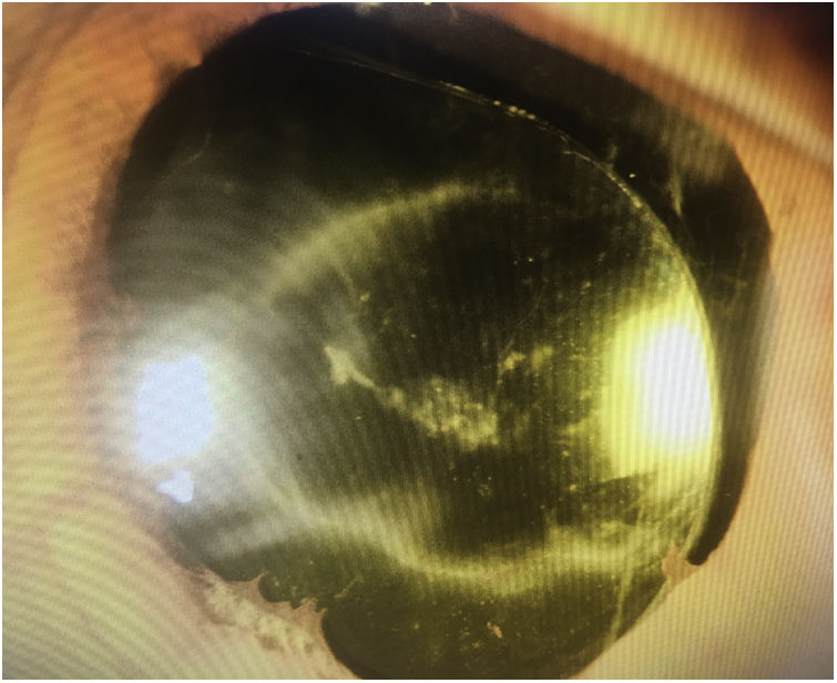 Advantages of combined cataract and vitrectomy surgery with the «Bag-In ...