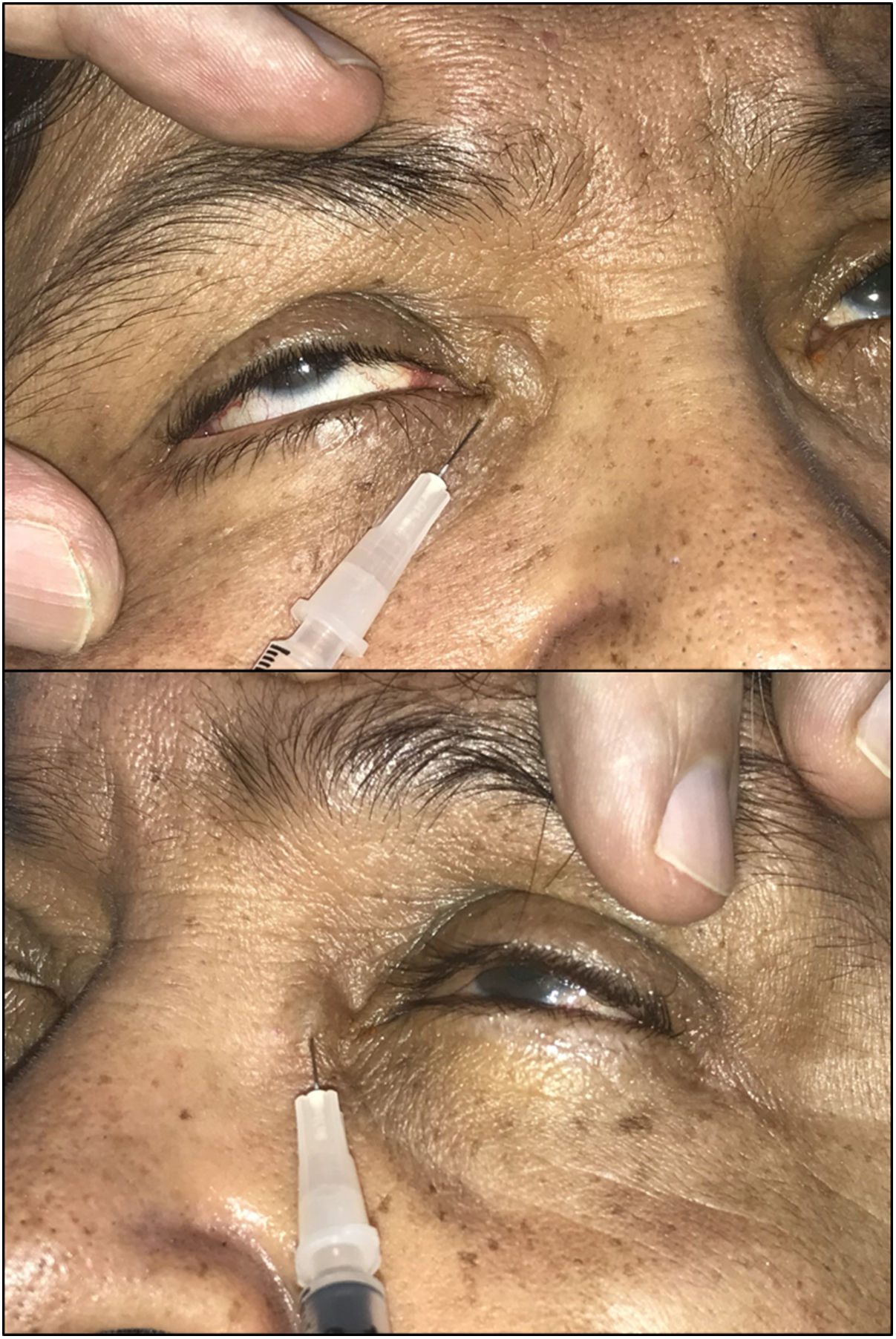 Application of botulinum toxin in Horner's muscle for the treatment of ...