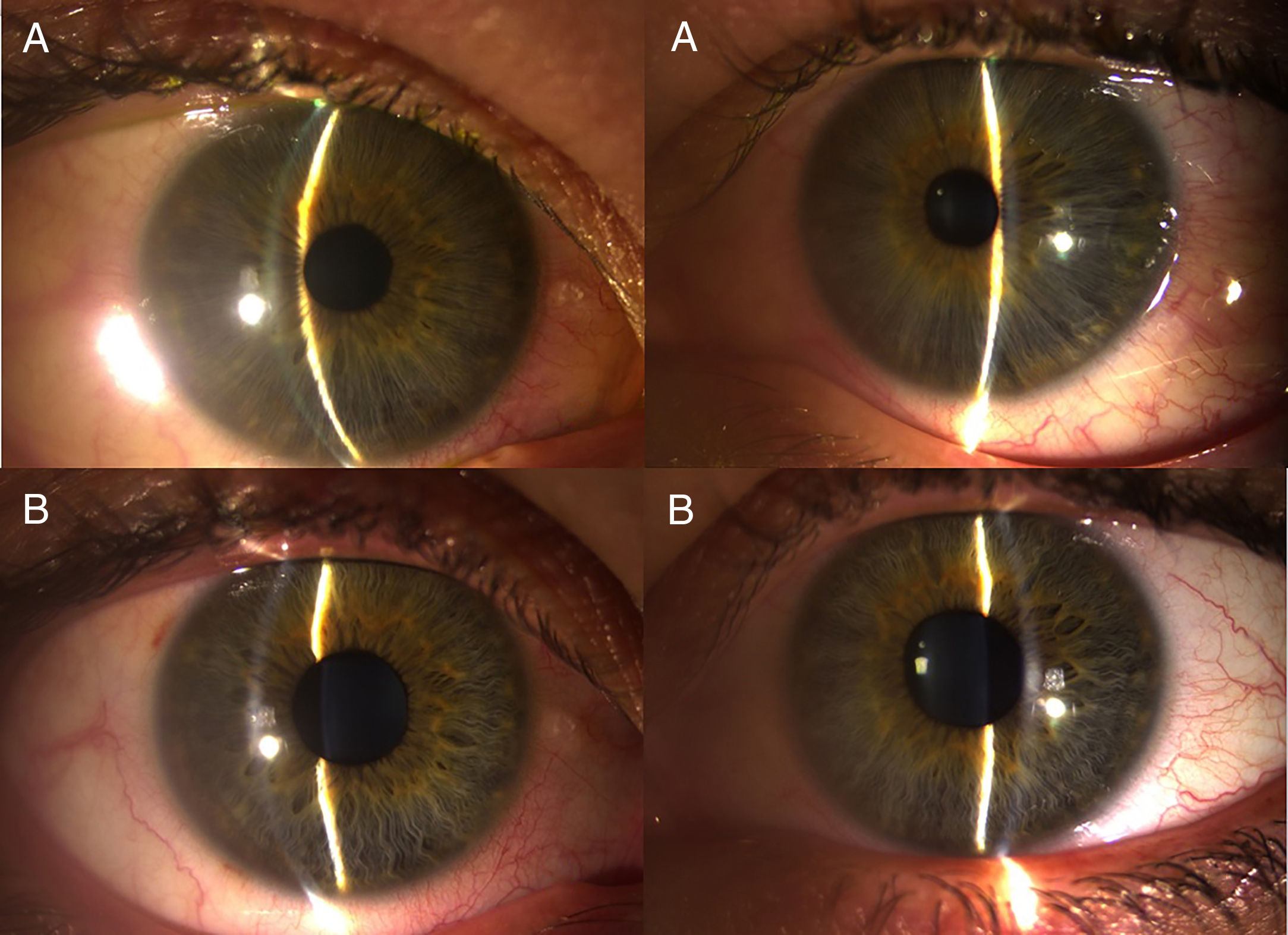 Acute narrow-angle glaucoma induced by topiramate with acute myopia and ...