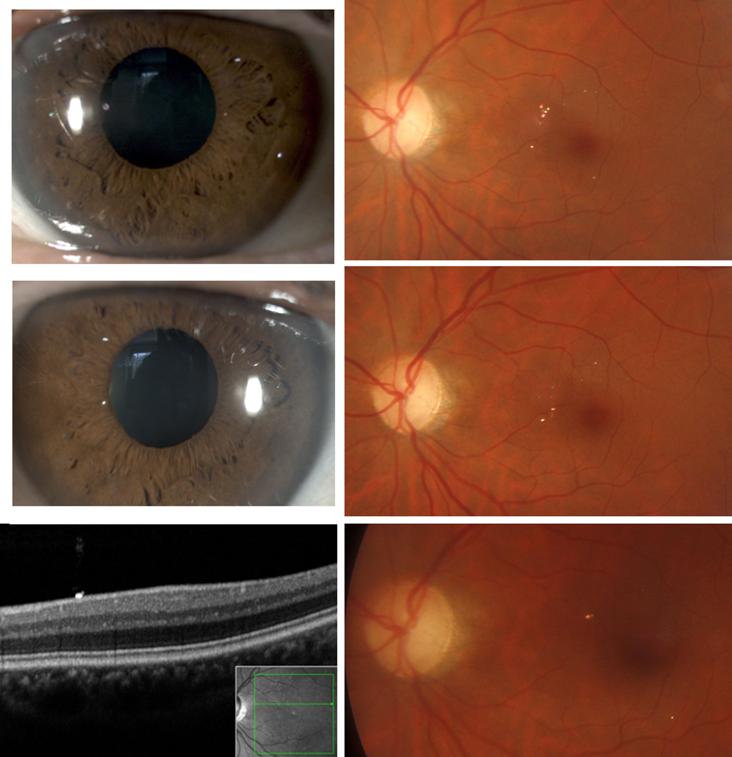 Intraocular crystals: A clinic sign of Fuchs' heterochromic cyclitis ...