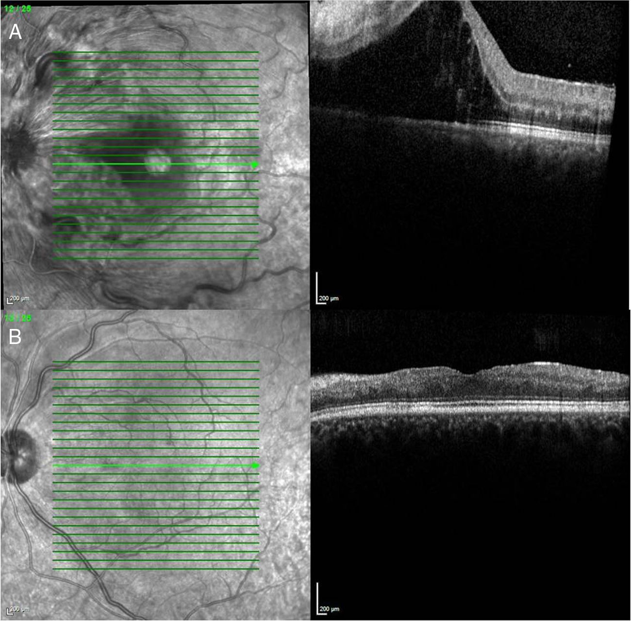 Papillophlebitis as manifestation of polyarteritis nodosa | Archivos de ...