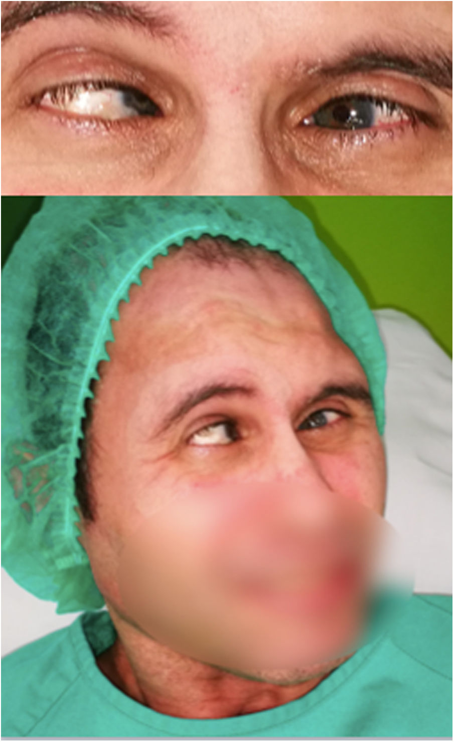 Nishida procedure associated with botulinum toxin in a long-standing ...