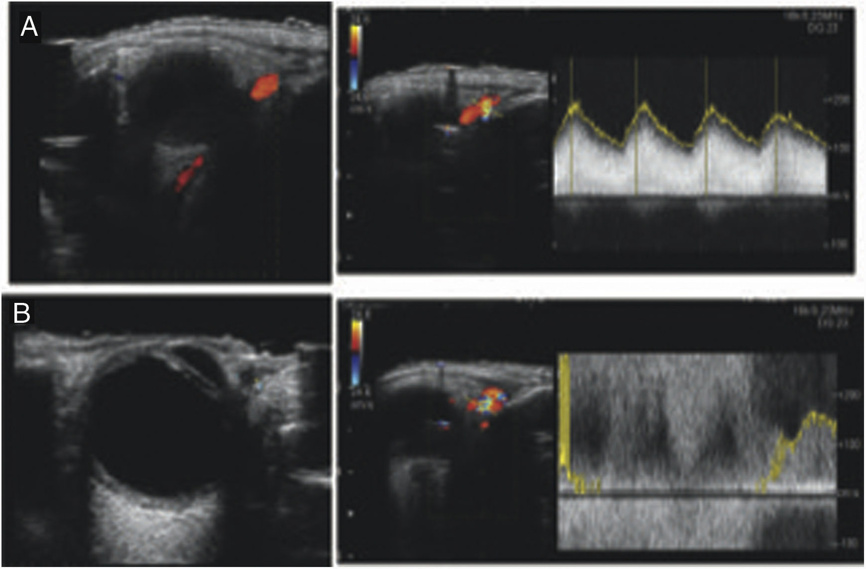 Orbital supratrochlear fistula secondary to anaesthetic block in ...