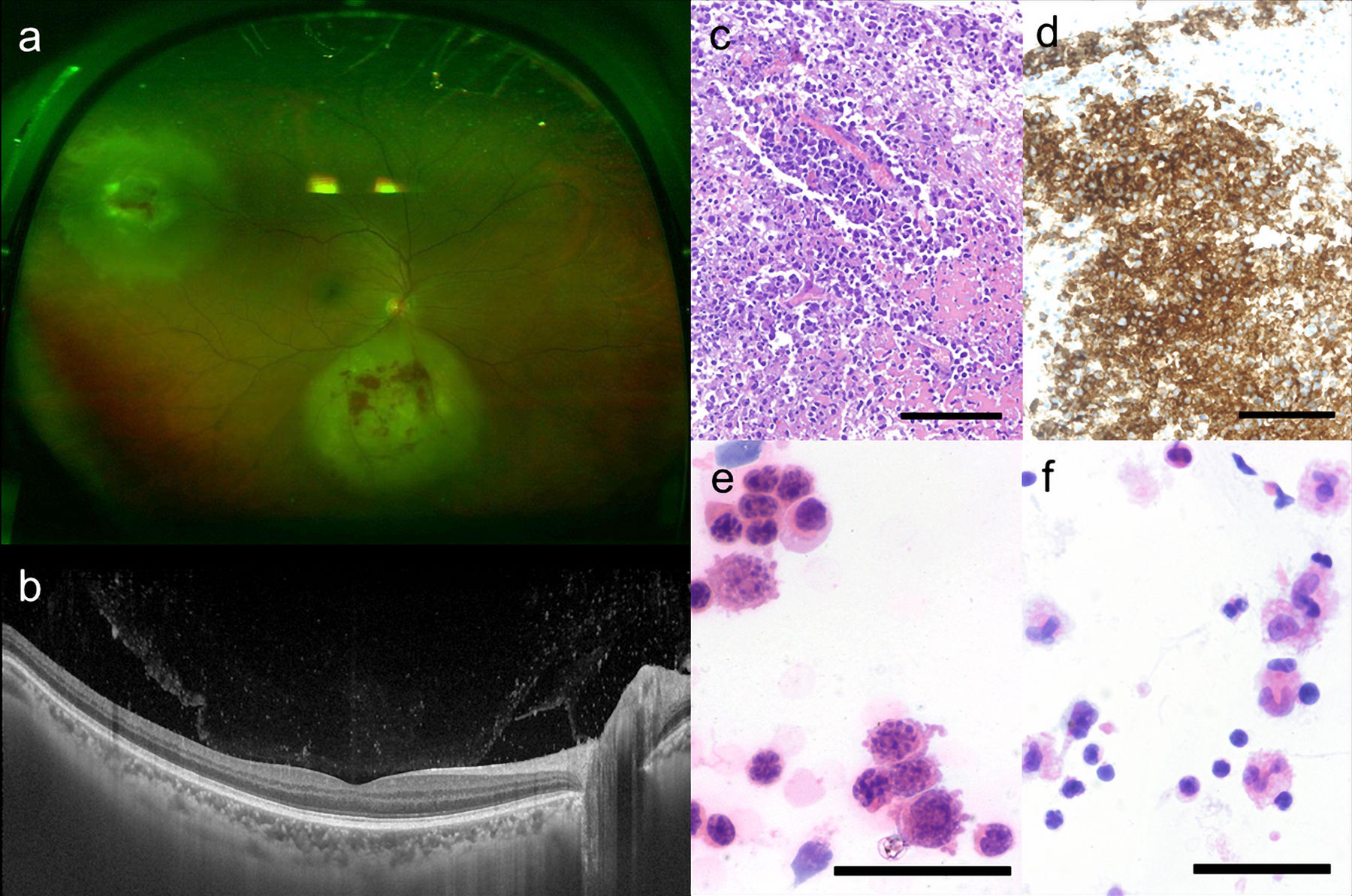 Diagnostic vitrectomy: a case series in a single referral center ...