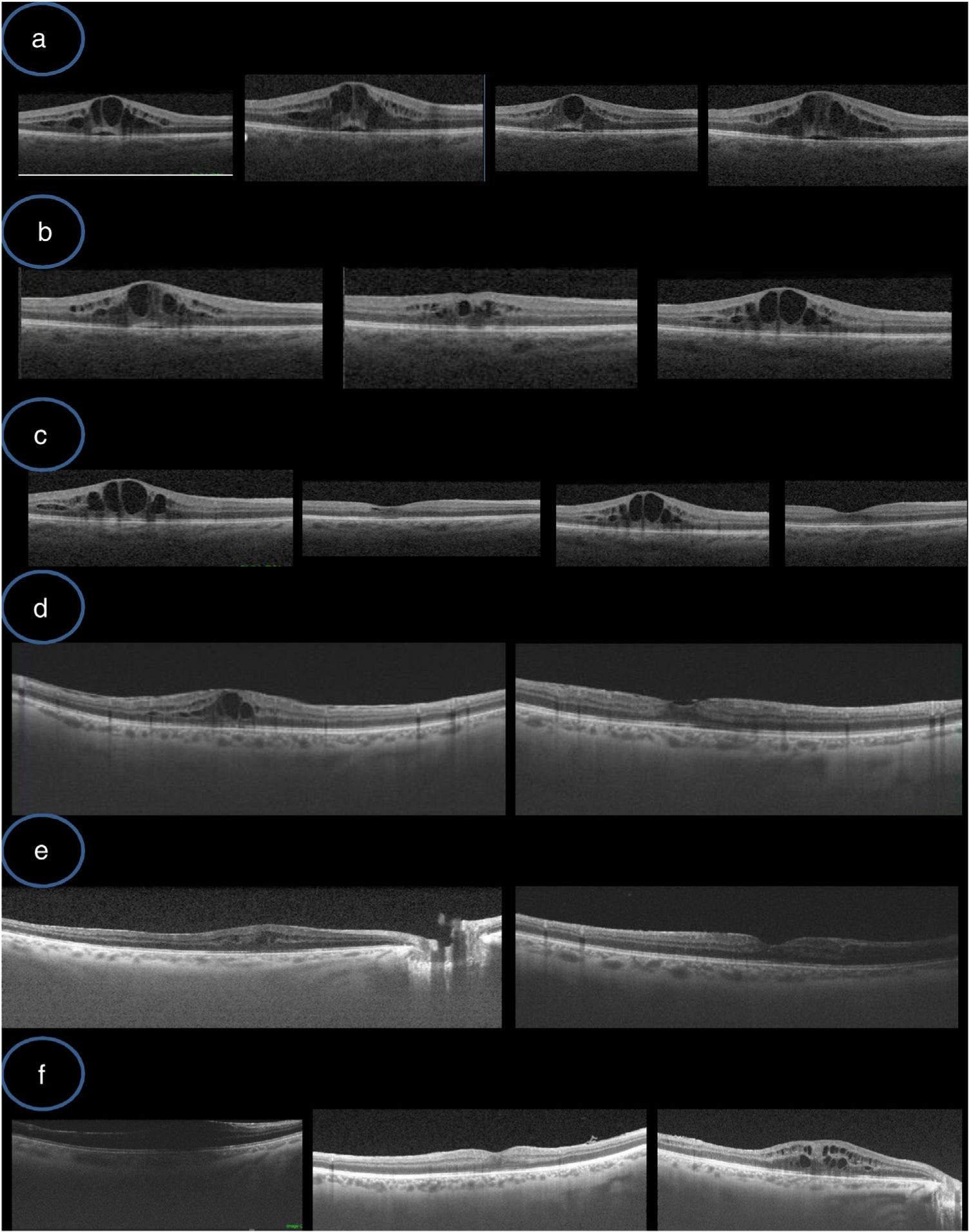 Immune recovery uveitis in a patient with herpes retinitis as a ...