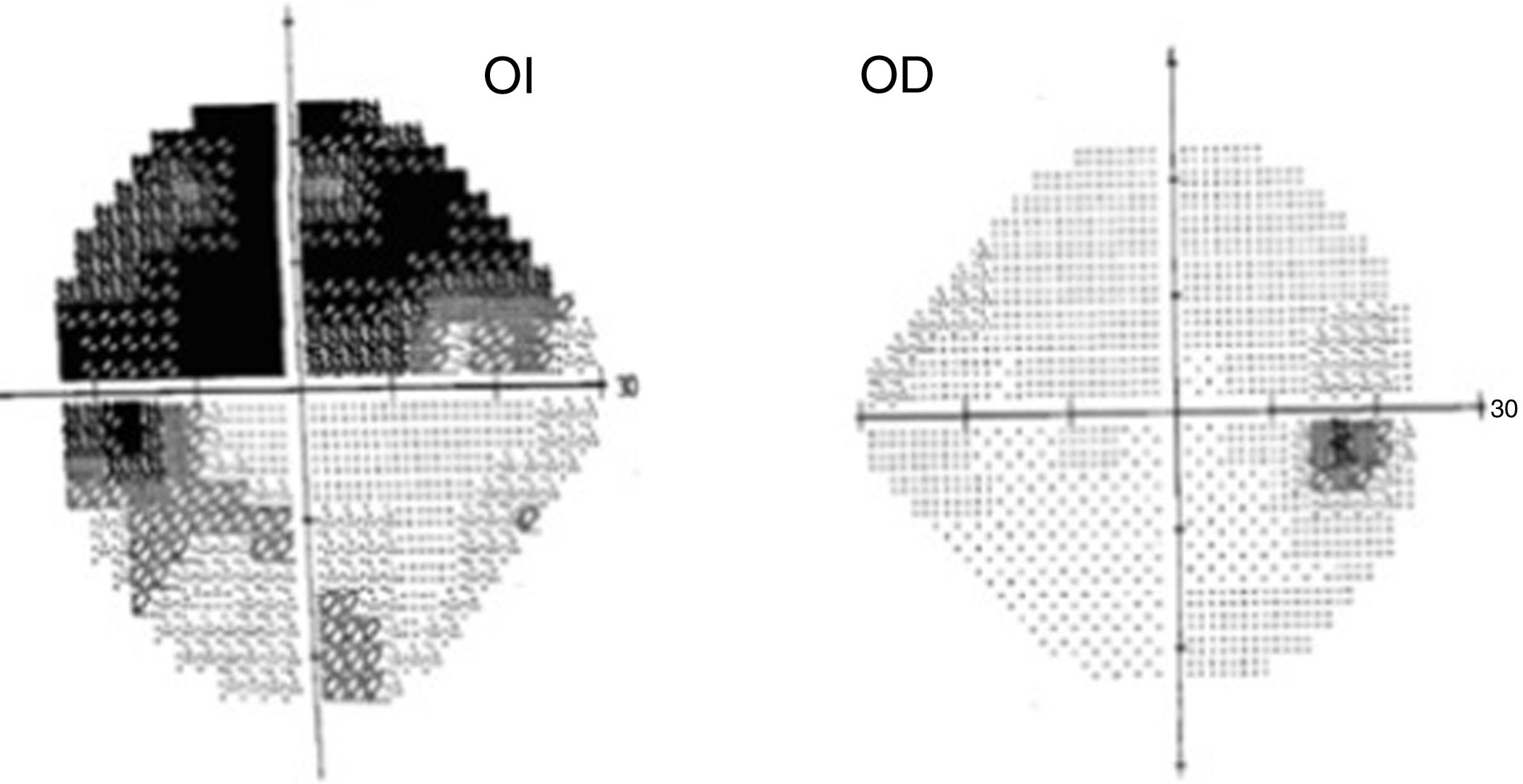 Pseudo-Foster Kennedy syndrome due to idiopathic intracranial ...